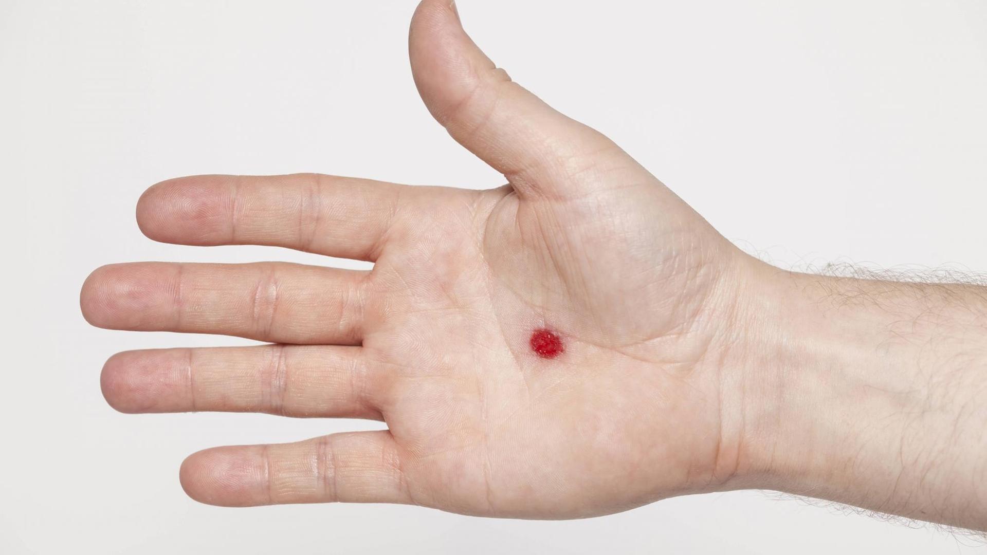 Heilung - Chronische Wunden | deutschlandfunk.de