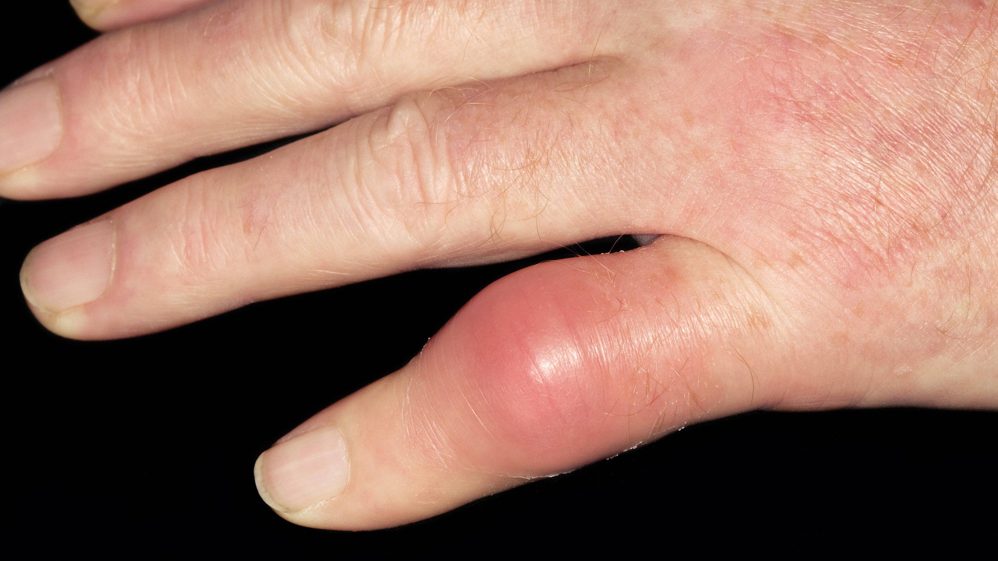 Arthritis - Fingerscanner ermöglicht genauere Diagnose | deutschlandfunk.de