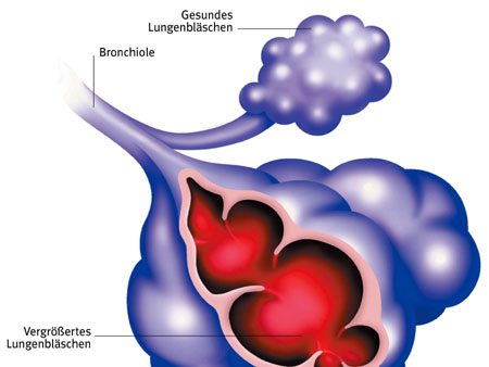 Mit Ventilen und Wasserdampf gegen die Atemnot | deutschlandfunk.de